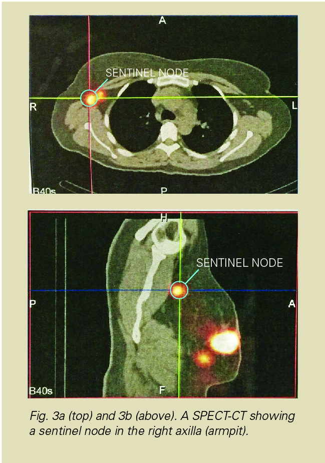 Sentinel Node Biopsy Westmead Breast Cancer Institute